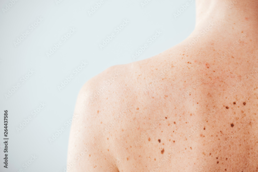 back view of diseased woman with melanoma on skin on white Stock Photo ...