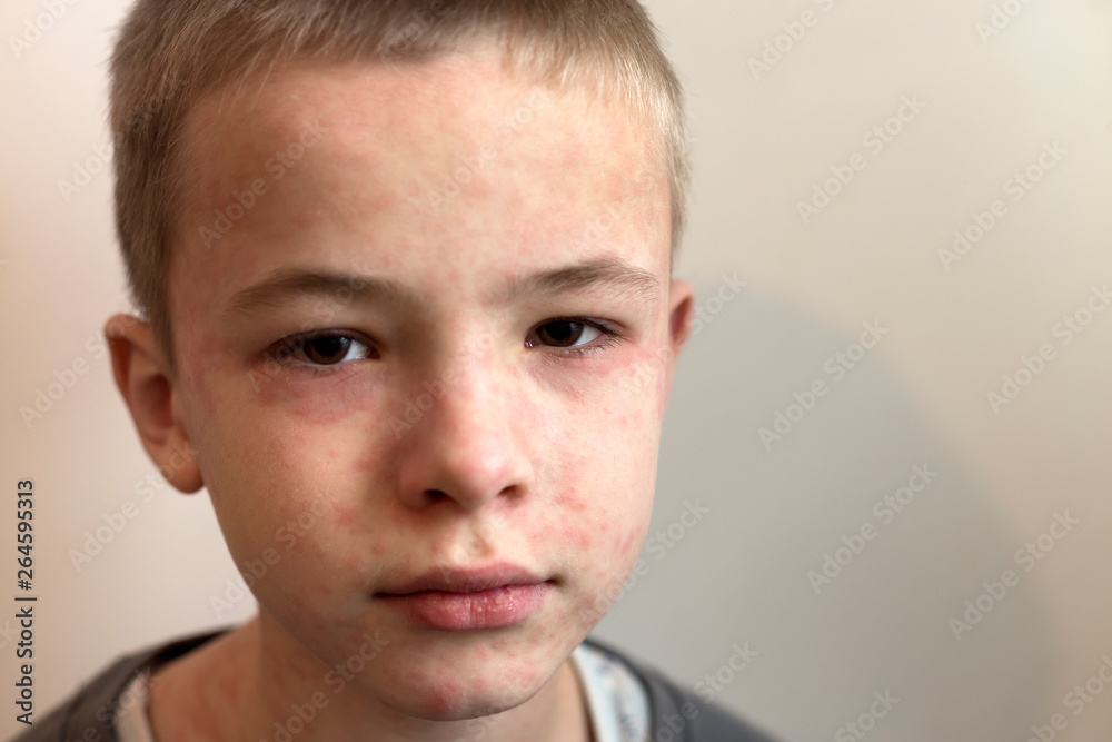 Portrait of sick sad boy child suffering from measles or chicken pox ...