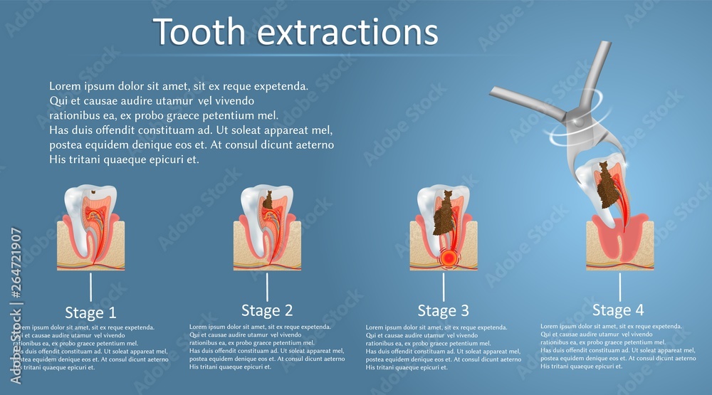 Tooth extraction concept vector poster banner template Stock Vector ...