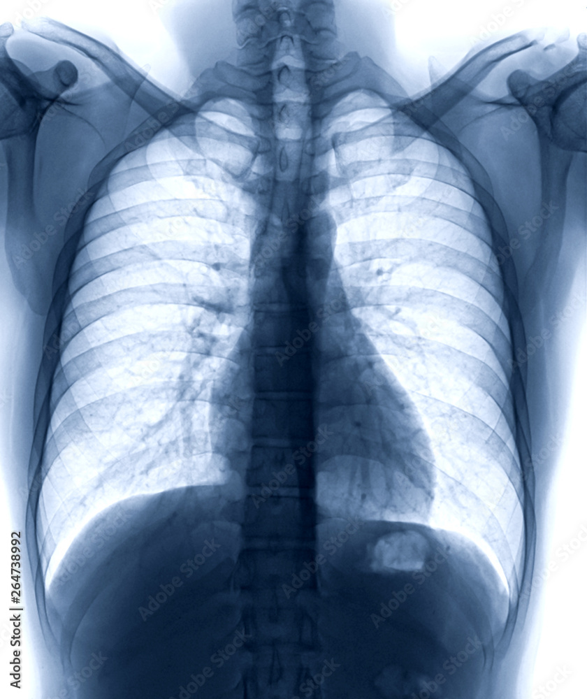 Chest X-ray or X-Ray Image Of Human with full inspiration for detect ...