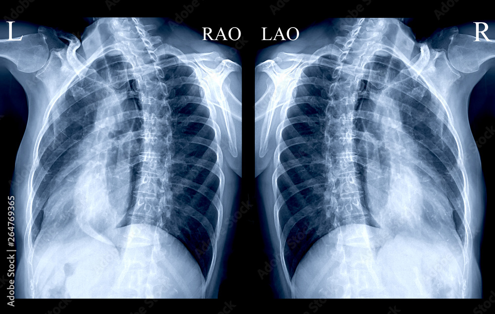 Chest X Ray Or X Ray Image Of Human Both Oblique View Or Both Side For Detect Fracture Rib From