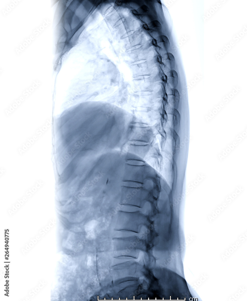 X-ray image of T-L spine or thoracolumbar spine lateral view for ...
