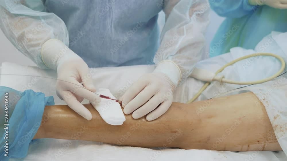Close up surgeon inserts a medical needle into patient leg during a ...