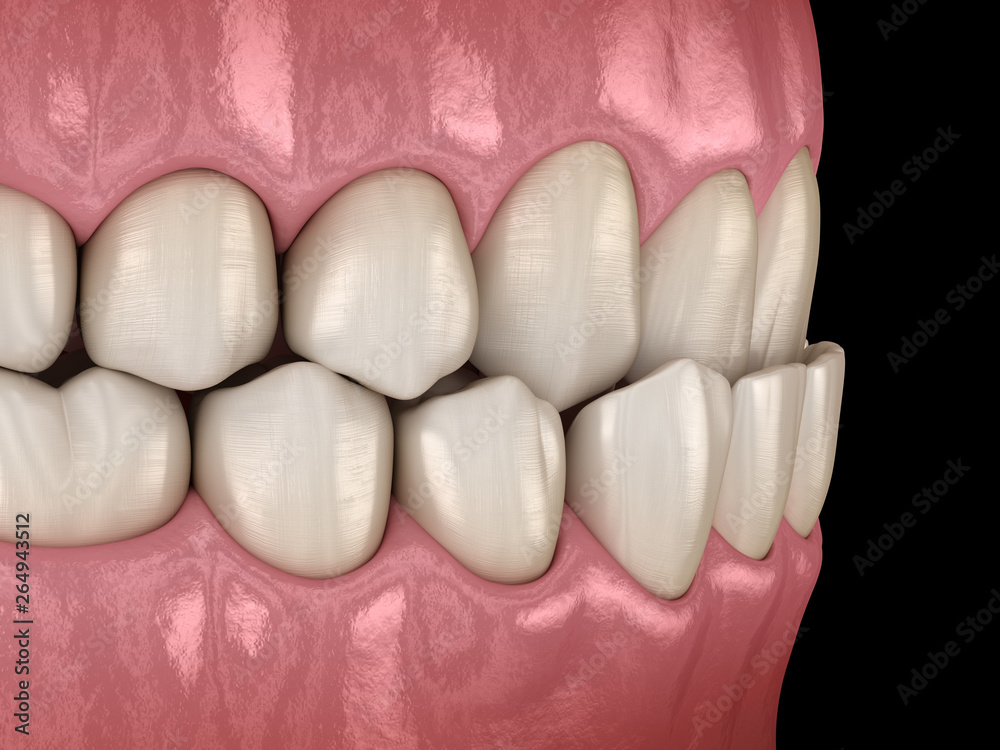 Underbite dental occlusion ( Malocclusion of teeth ). Medically ...