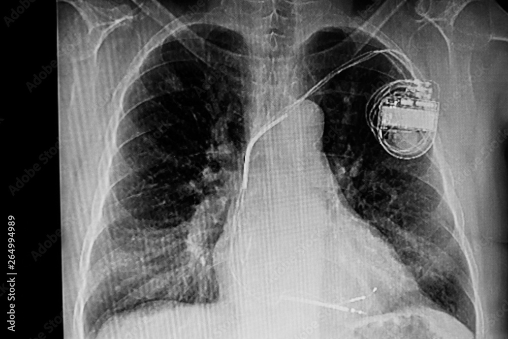Chest X- Ray of a male patient with heart pacemaker and right lower ...