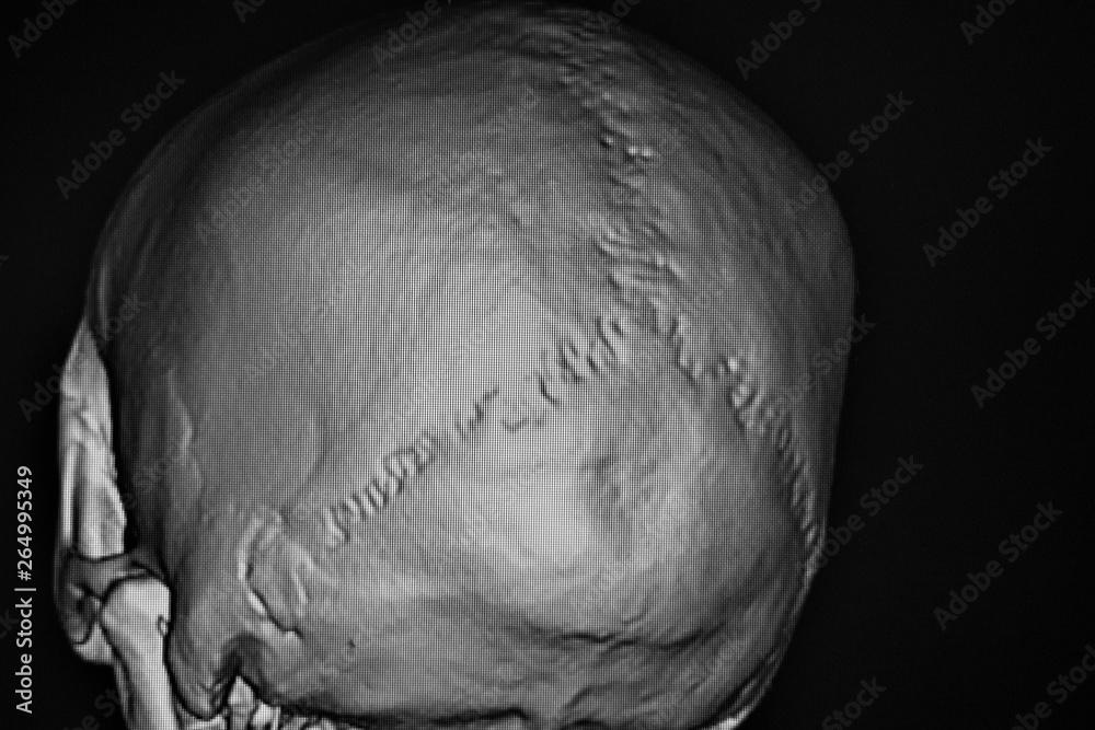 MRI Craniotomy skull brain trauma Stock Photo | Adobe Stock