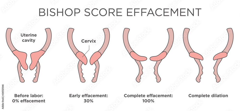 Poster Medical illustration diagram - Bishop Score Effacement levels ...