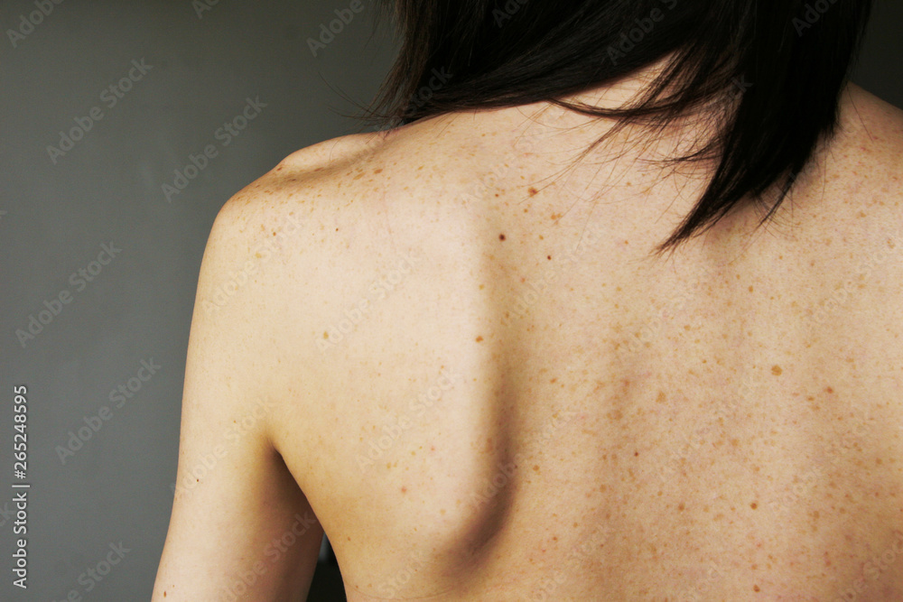 freckles and moles on the girl's back Stock Photo | Adobe Stock