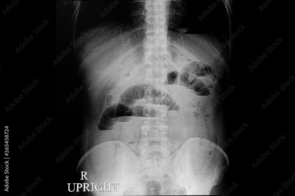 abdominal xray film of a patient with small bowel obstruction Stock ...