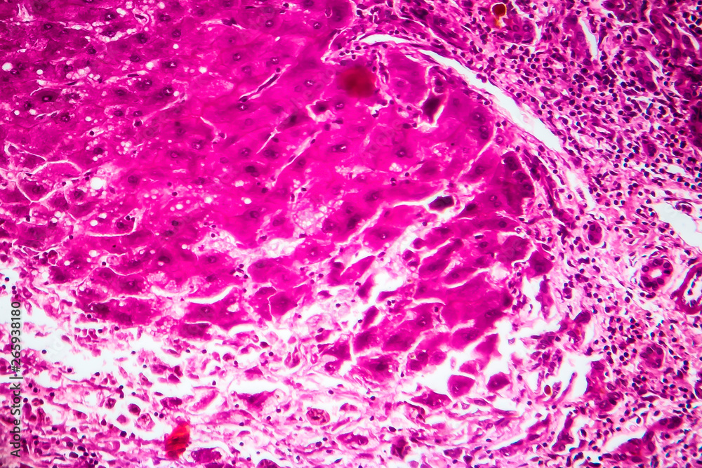 Histopathology of subacute severe hepatitis, light micrograph, photo ... Histopathology of subacute severe hepatitis, light micrograph, photo ...
