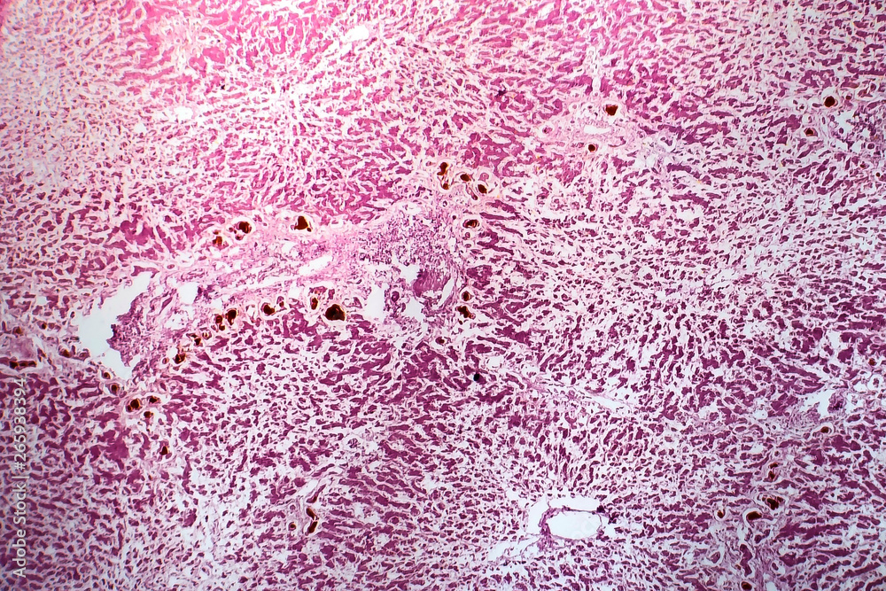Histopathology of acute severe hepatitis, light micrograph, photo under ... Histopathology of acute severe hepatitis, light micrograph, photo under ...