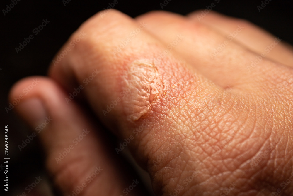 Snake bite of index finger in detailed macro image. Detail of wounding ...