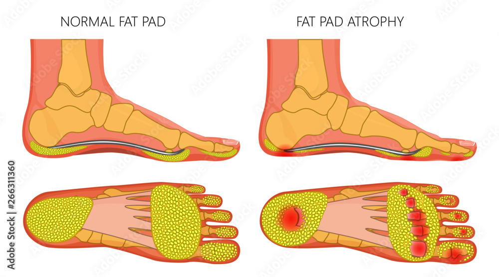 Vector illustration, diagram of a healthy foot and a foot with a fat ...