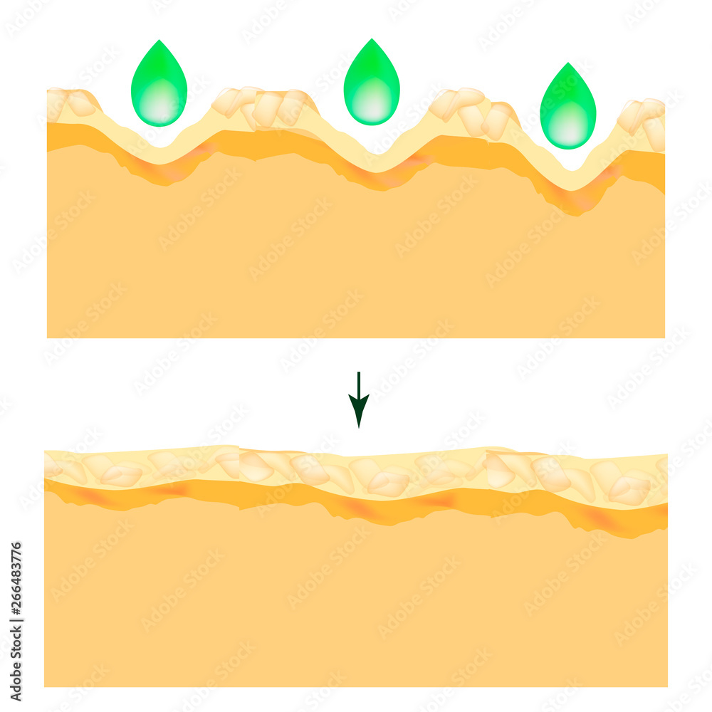Enlarged pores. The structure of the skin. Wrinkles, acne scar ...