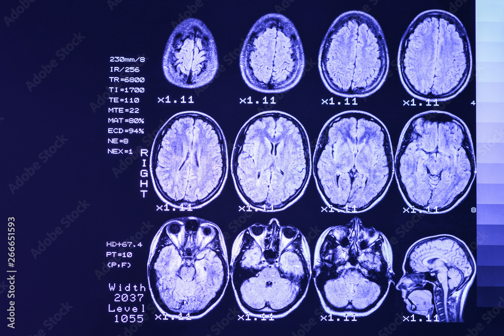 MRI scan or magnetic resonance image of head and brain scan. The result ...