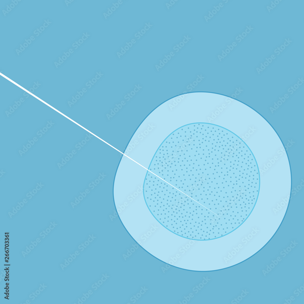 Medical operation, syringe thin needle or laser in cell invitro ...