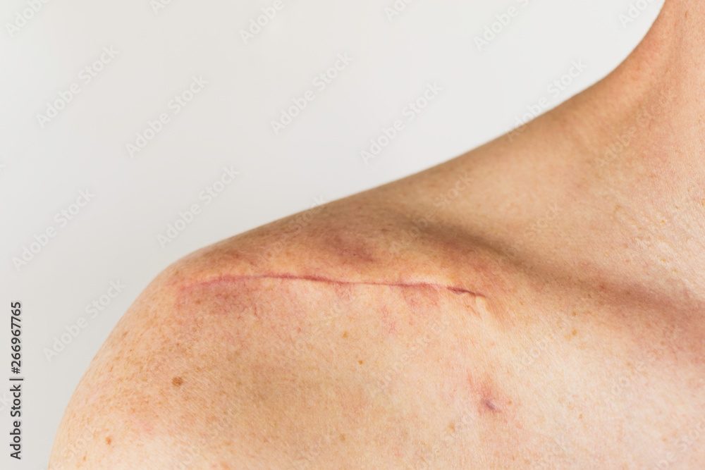 scar on the of a male body after surgery on a broken collarbone ...