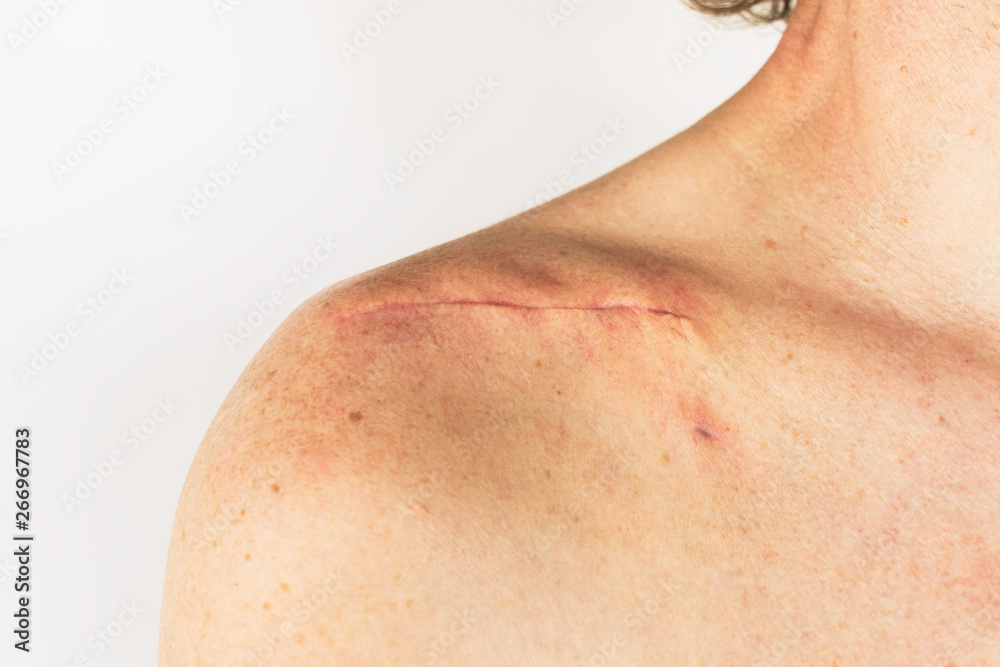 scar on the of a male body after surgery on a broken collarbone ...