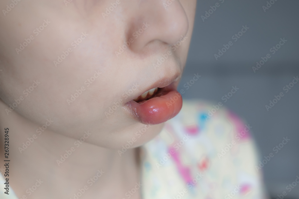 Closeup Swollen Lip Of Asian Woman Caused By Insect Bite Insect Sting Allergy Lip Swollen