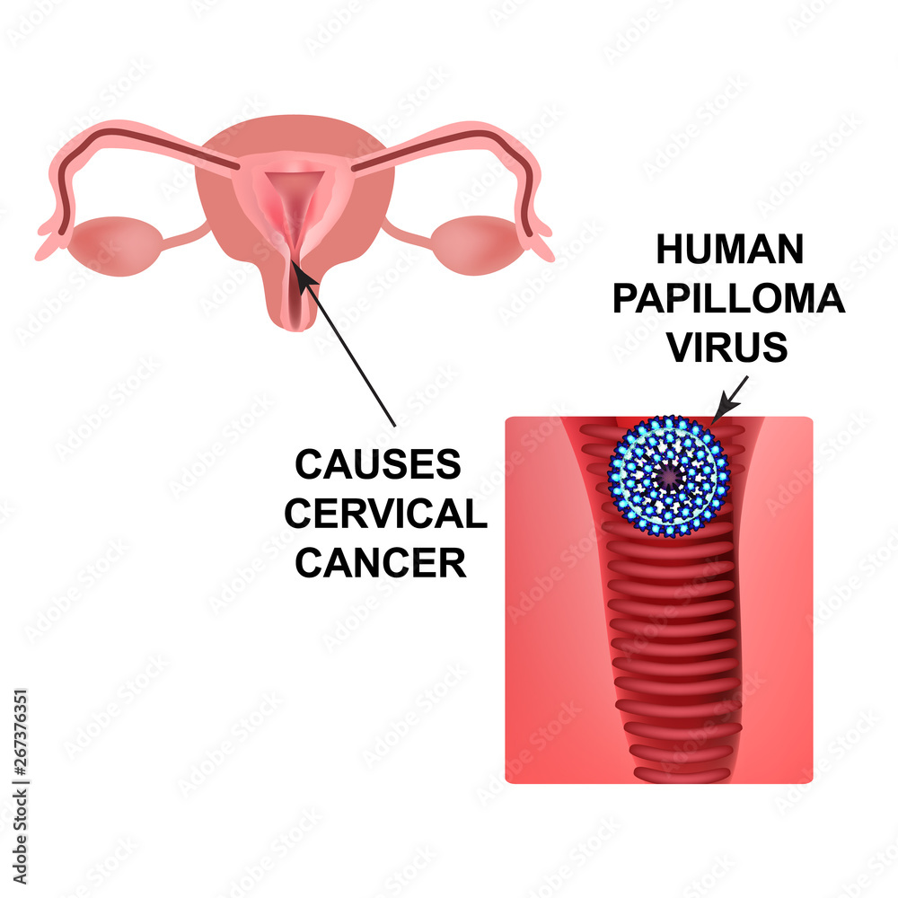 Human Papilloma Virus. Causes cervical cancer. The structure of the ...