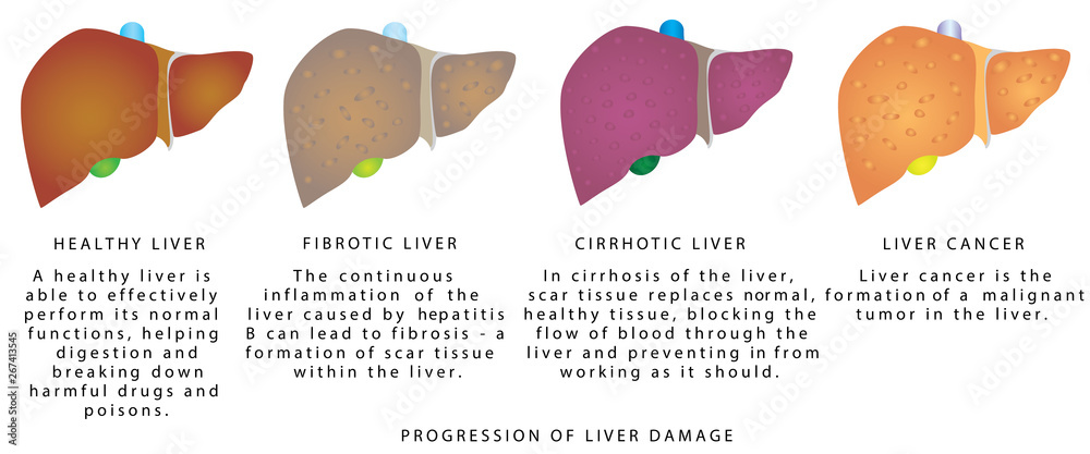 Liver disease. Stages of liver damage. Liver disease anatomy ...