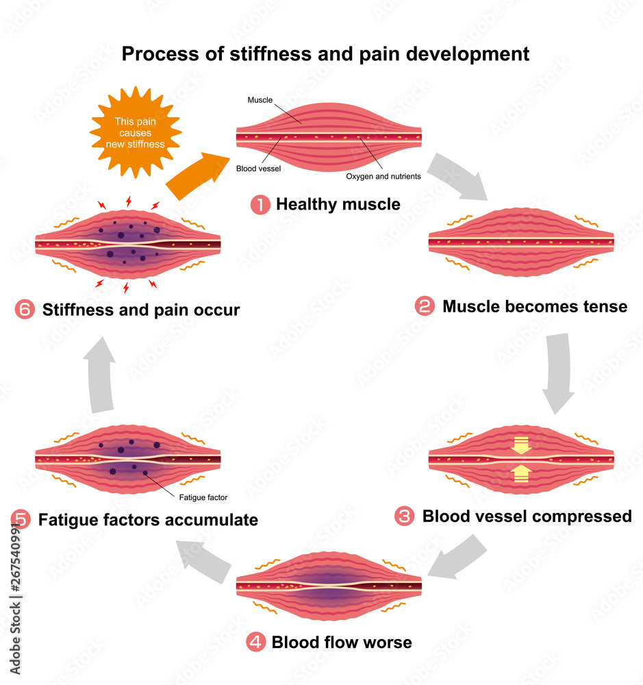 Process of muscle's stiffness and pain / circle type illustration Stock ...