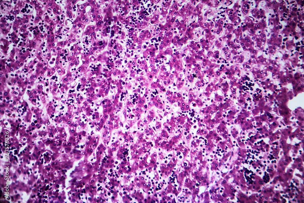 Histopathology of chronic active hepatitis, light micrograph, photo ...