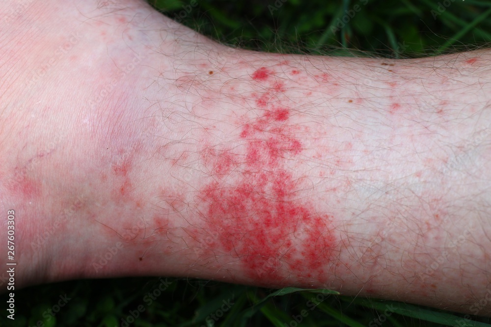 Rash on the skin after biting a bee Stock Photo | Adobe Stock