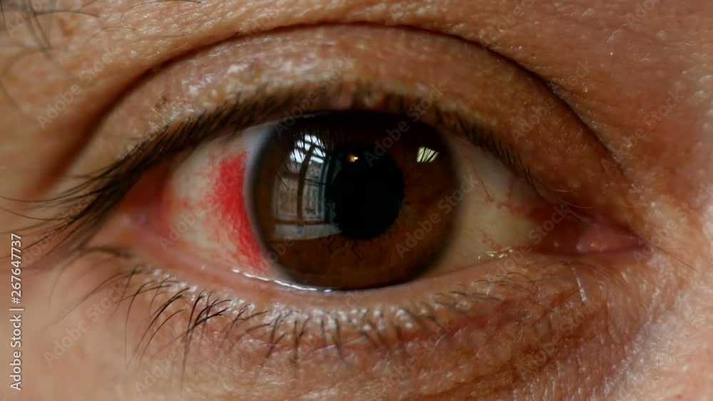 Opening and closing tired sick annoyed eye with broken blood vessels ...