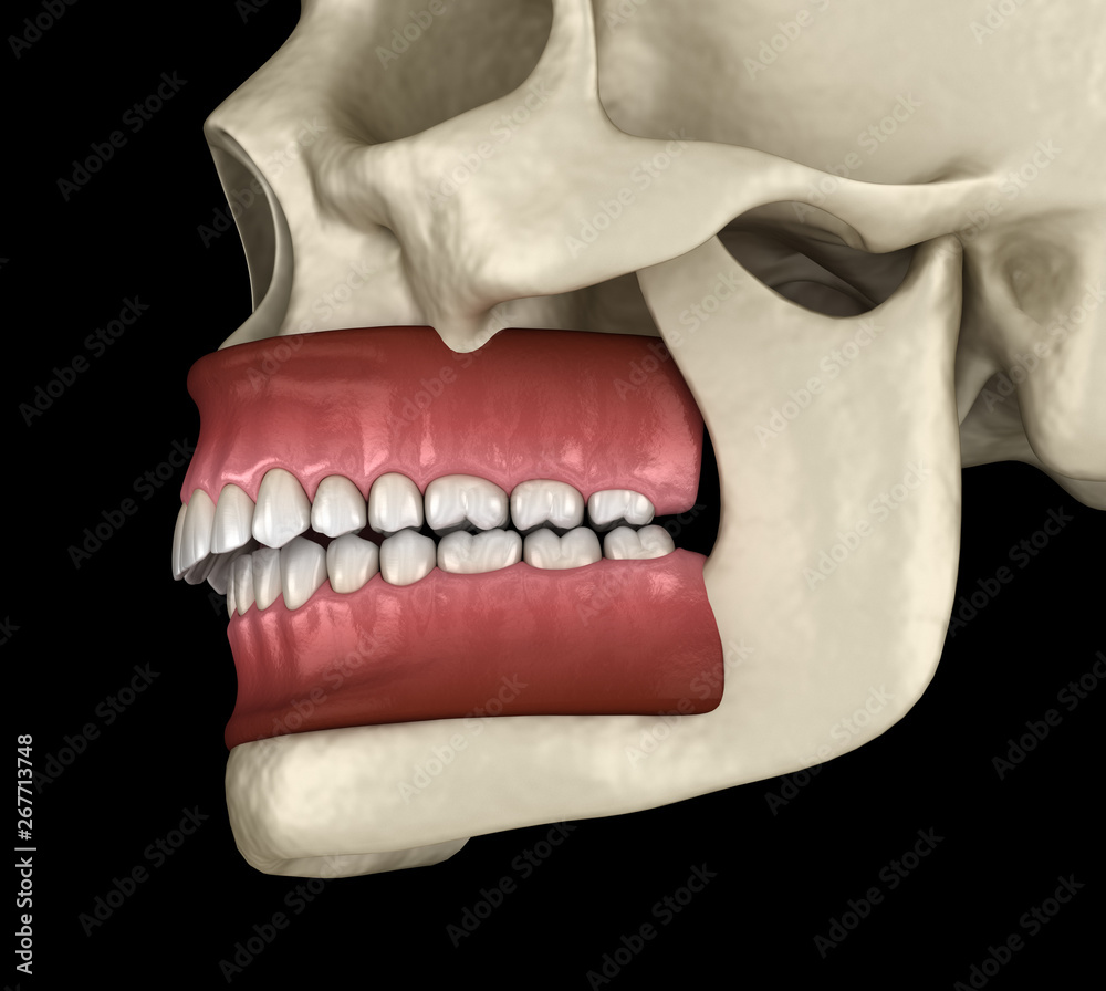 Overbite dental occlusion ( Malocclusion of teeth ). Medically accurate ...