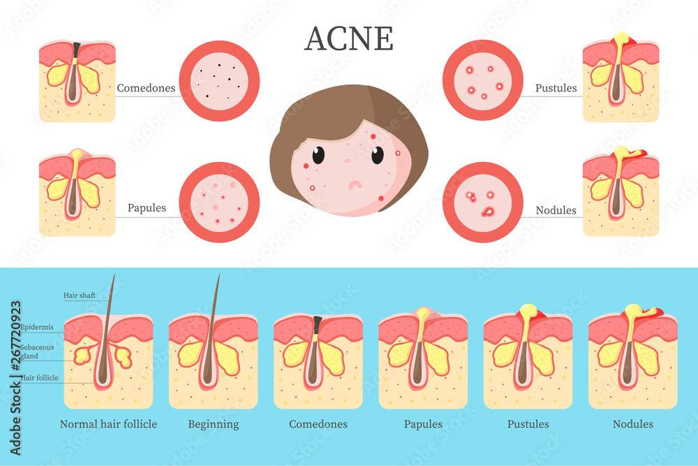 Acne types and formation infographics, vector flat illustration Stock ...