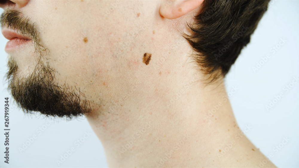 Moles On Neck