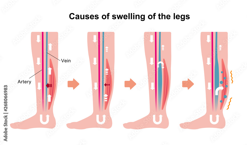 Cause of swelling(edema) of the legs. flat illustration. Stock Vector ...