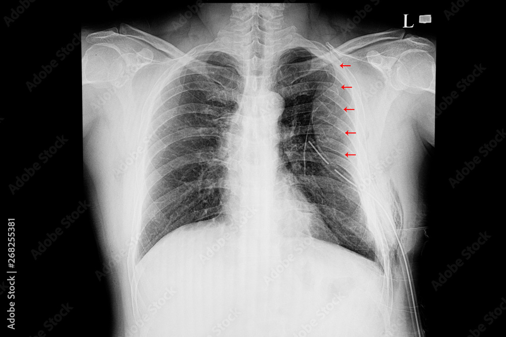 chest xray film of a patient with multiple rib fractures Stock Photo ...