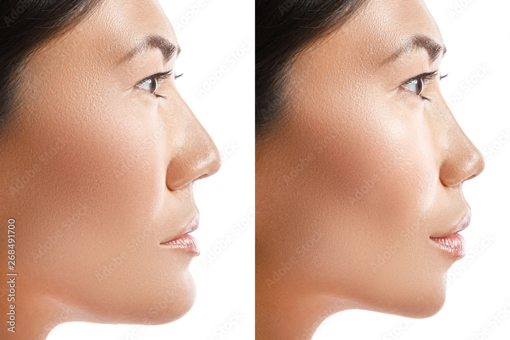 Transformation of Asian woman. Result of plastic surgery. Stock Photo ...
