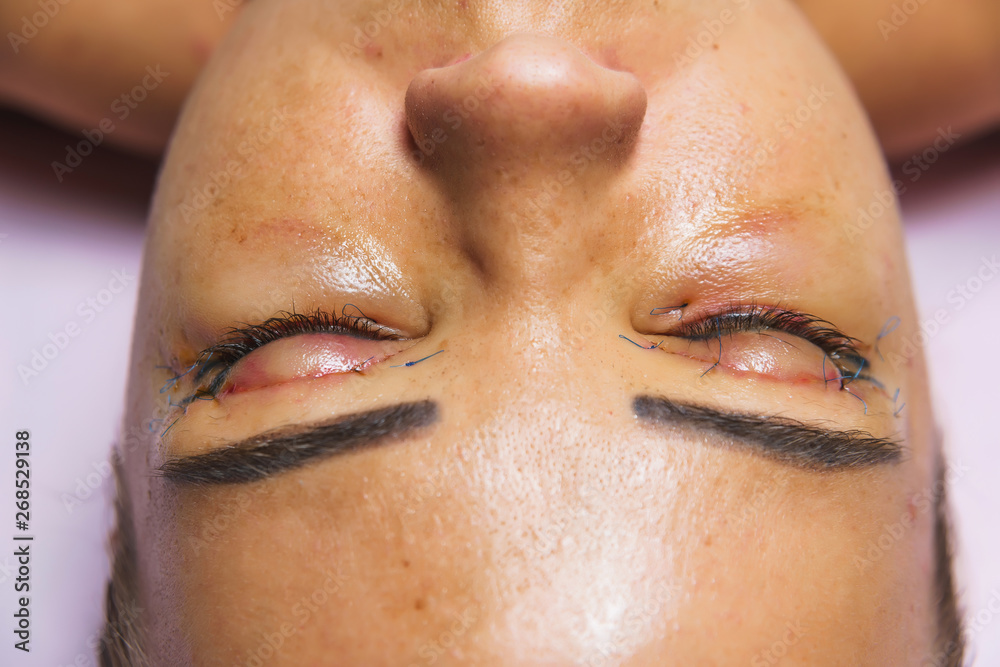 Woman after plastic surgery on the eyes. Stitches on the eyelids after ...