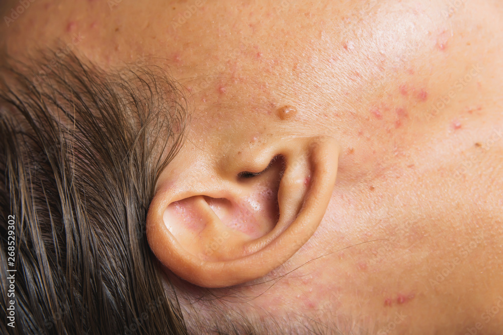 Acne and wen on the skin of the face near the ears close-up. Female ...