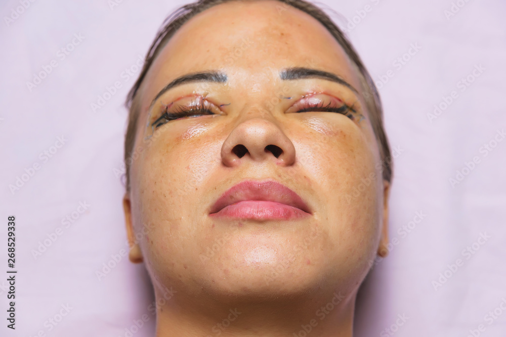 Woman after plastic surgery on the eyes. Stitches on the eyelids after ...