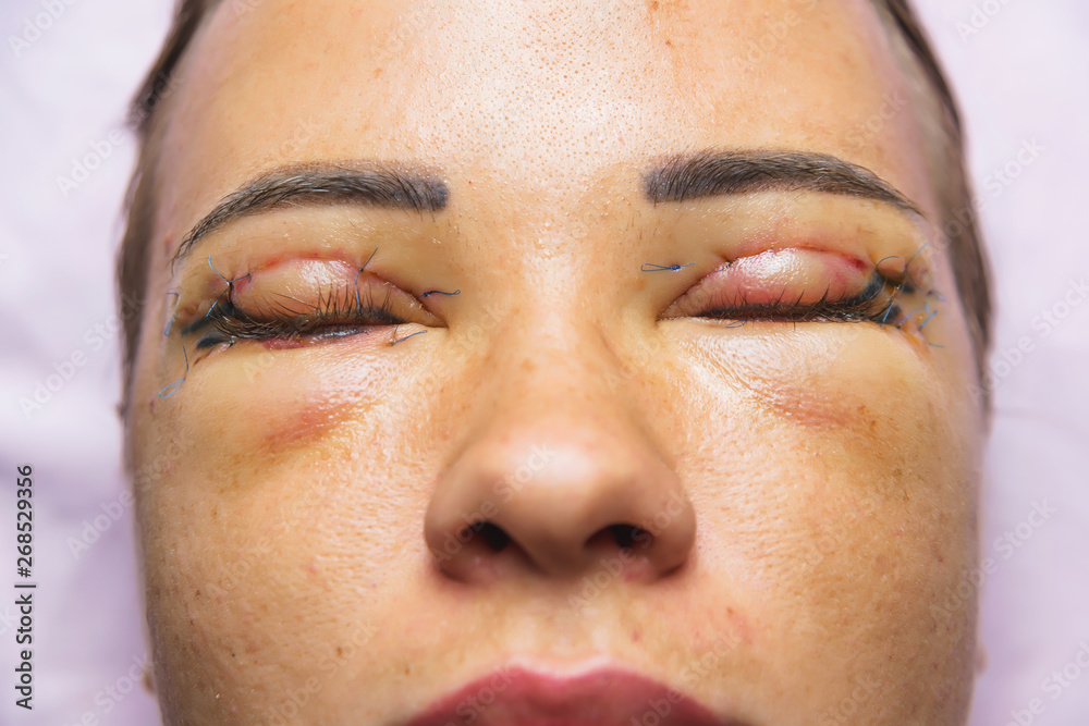 Woman after plastic surgery on the eyes. Stitches on the eyelids after ...
