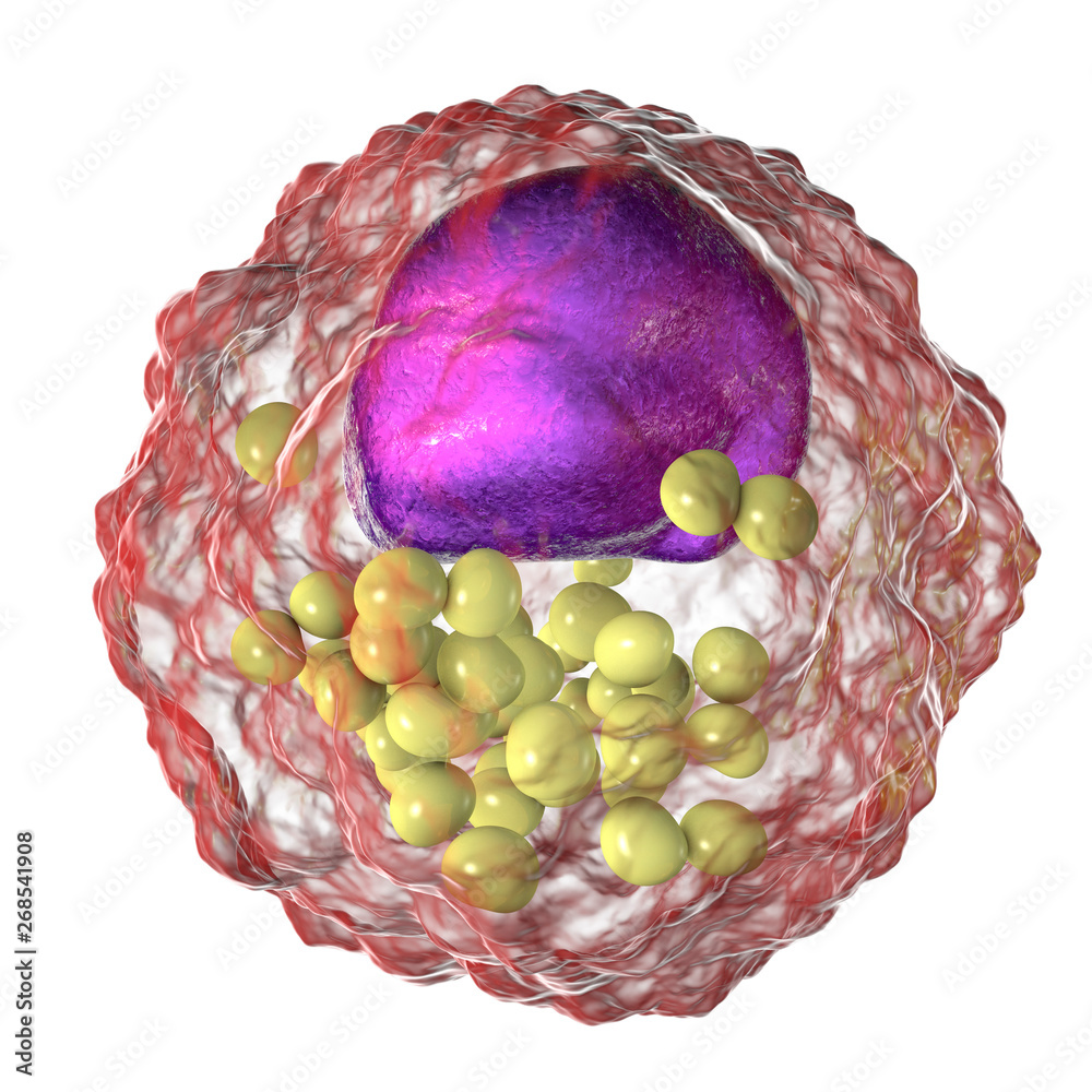 Foam Cell Macrophage Cell That Contain Lipid Droplets And Are Components Of Atherosclerotic