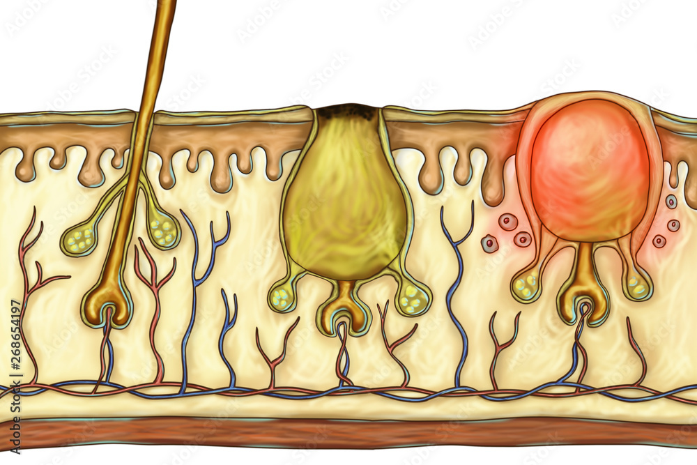 Histology of acne lesions. Illustration showing normal hair with ...