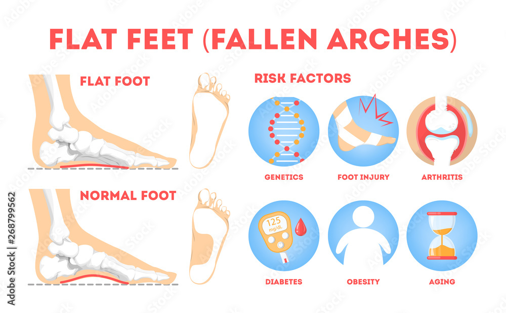 Foot pathologies infographic. Flat foot anatomy. Deformed Stock Vector ...