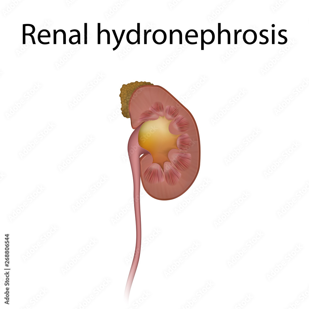 Hydronephrosis. Distended renal kidney pelvic. Realistic anatomy vector ...