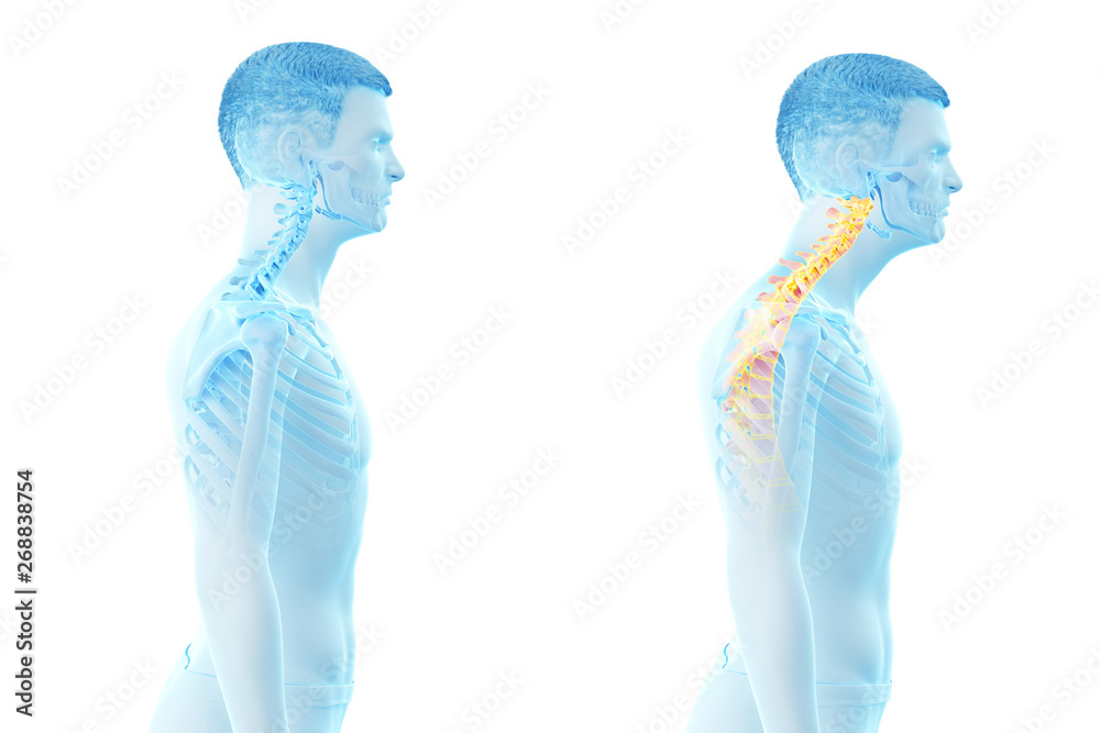 3d rendered medically accurate illustration of a man with a forward ...
