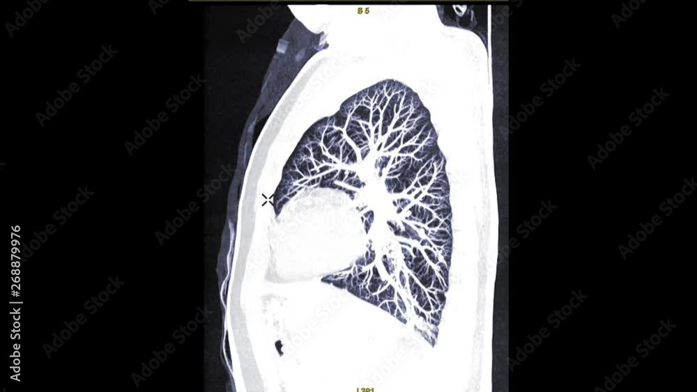 CTA Chest with contrast media Sagittal MIP view for diagnostic ...