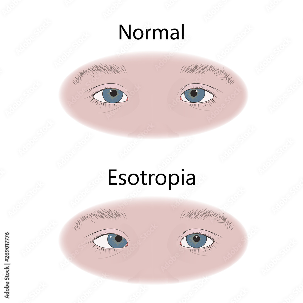 Strabismus in infants, child, kid. Cross-eyed, esotropia, inward eyes ...