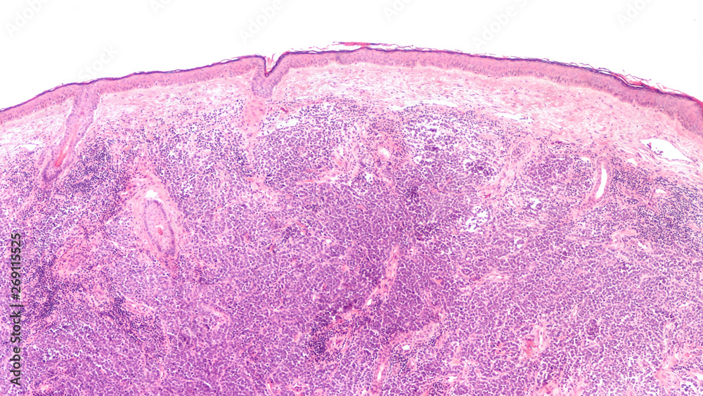 Microscopic image (photomicrograph) of a Merkel cell carcinoma, a ...