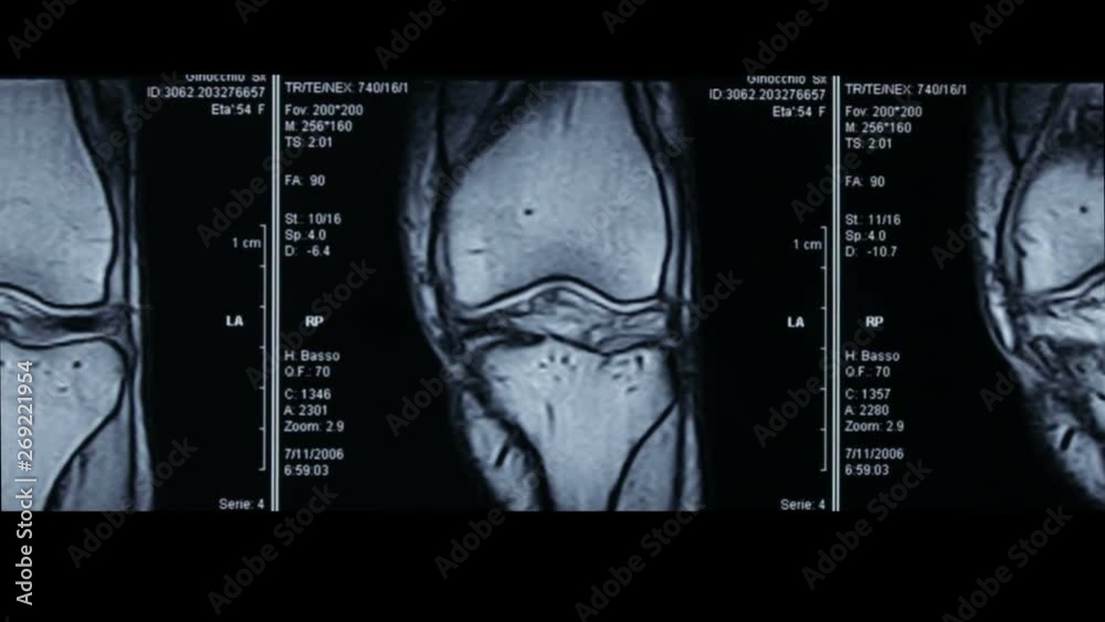 Zoom-in video of R.M.N. Nuclear magnetic resonance, of human knees ...