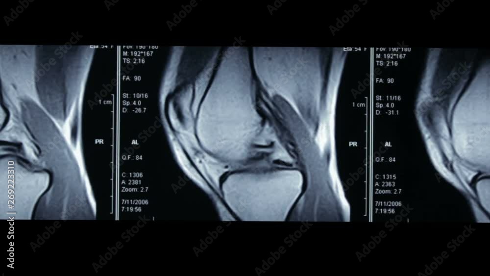 Zoom-in video of R.M.N. Nuclear magnetic resonance, of human knees ...