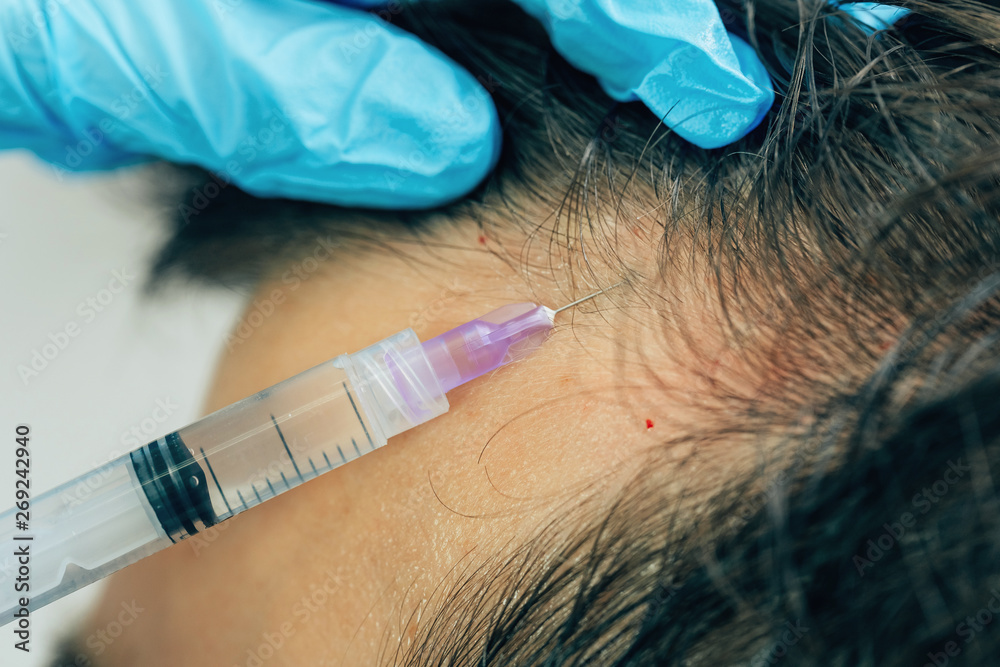Foto de Mesotherapy of hair and head. Injections in the head. Fighting ...